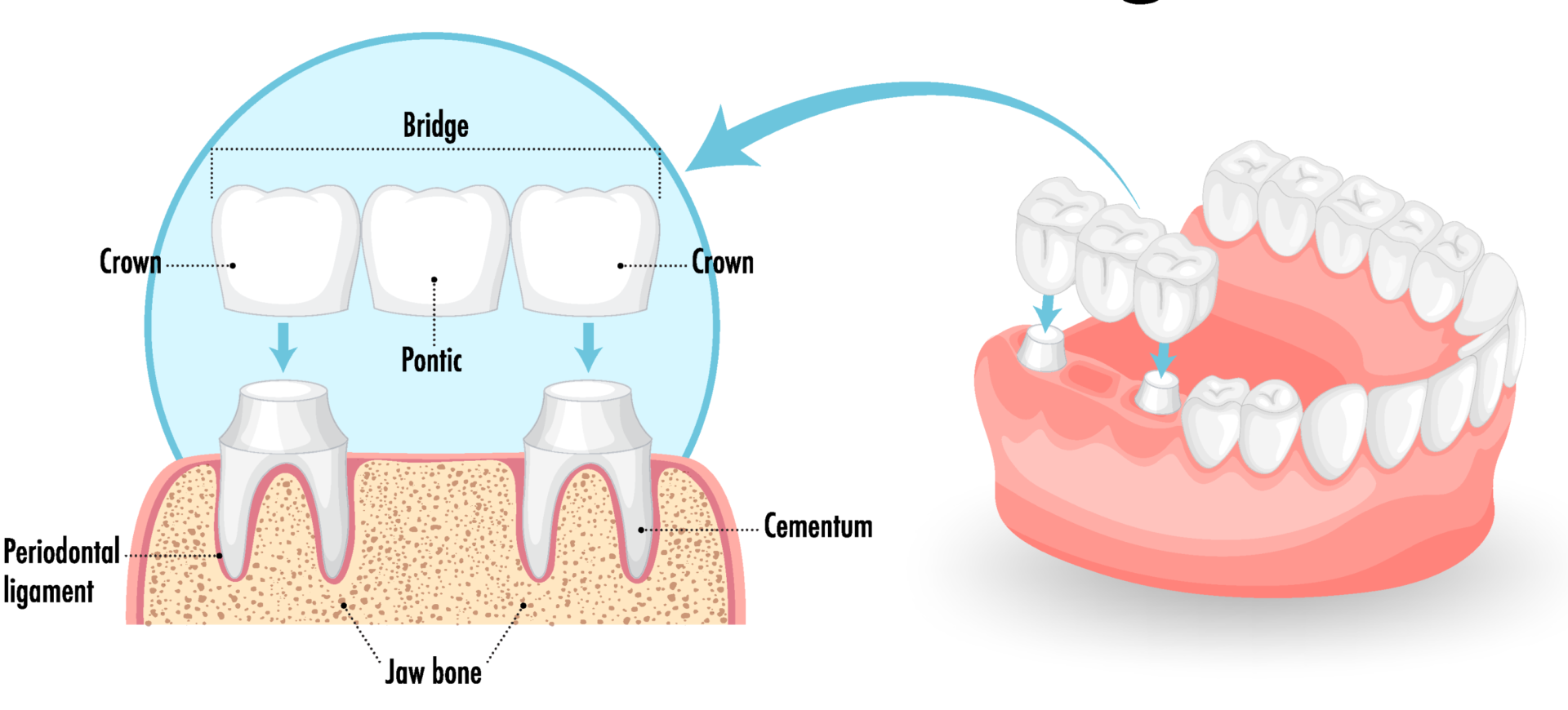 Dental Bridges | Burns Dentistry